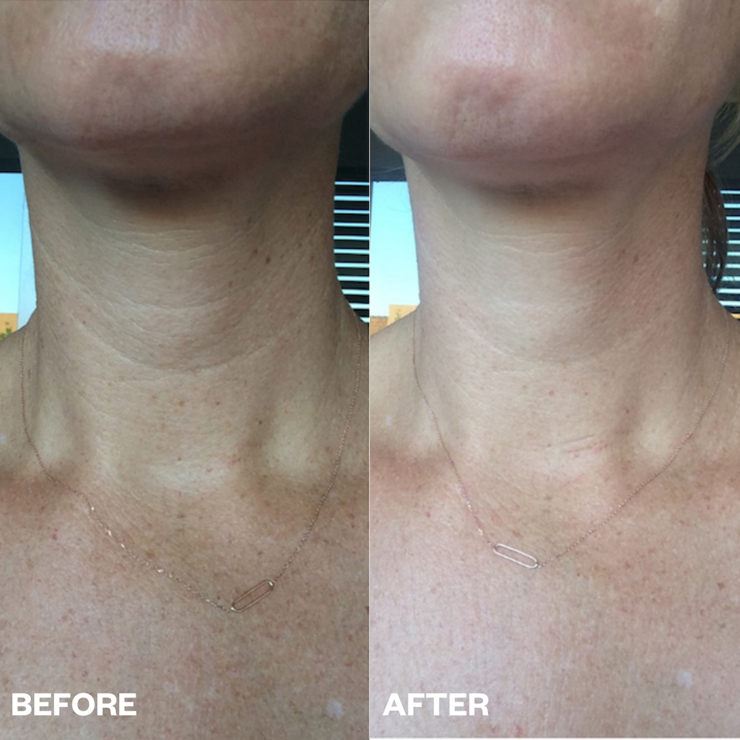 Neck Wrinkle Patch – Slender Me Medical